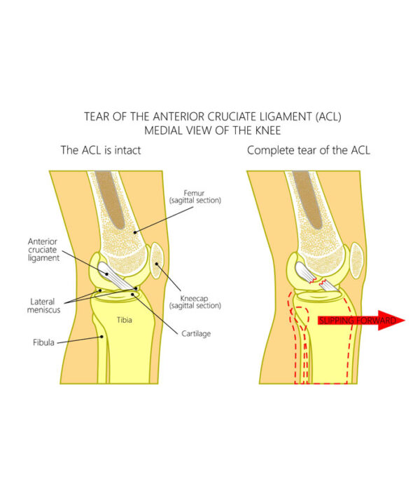 ACL Reconstruction Surgery in Nottingham | Expert Knee Surgeon